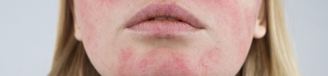 Treatment of Couperose and Rosacea - Clinique de la Croix d'Or
